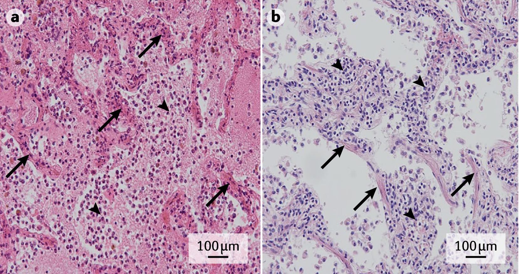 Pneumoni - Patofysiologi.dk